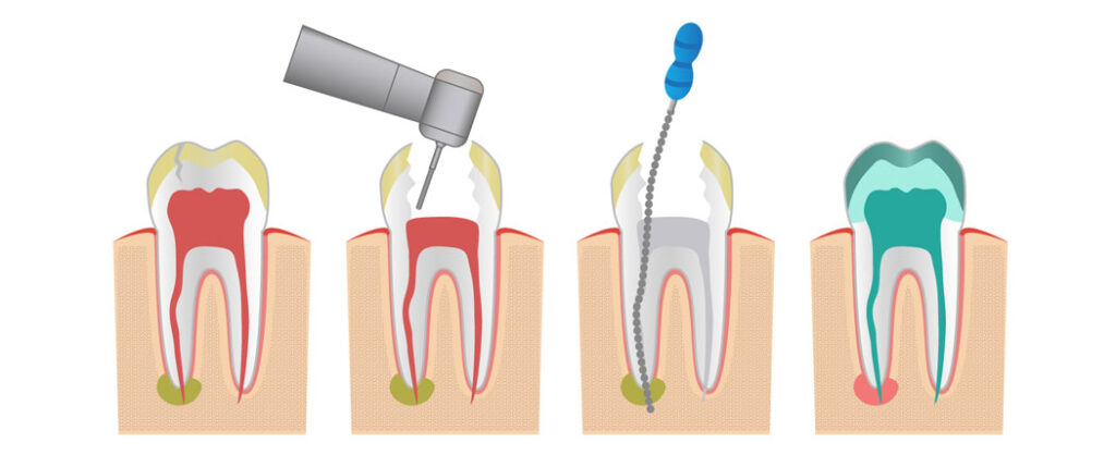 Endodontics - Premiere Dental Endodontics - Premiere Dental