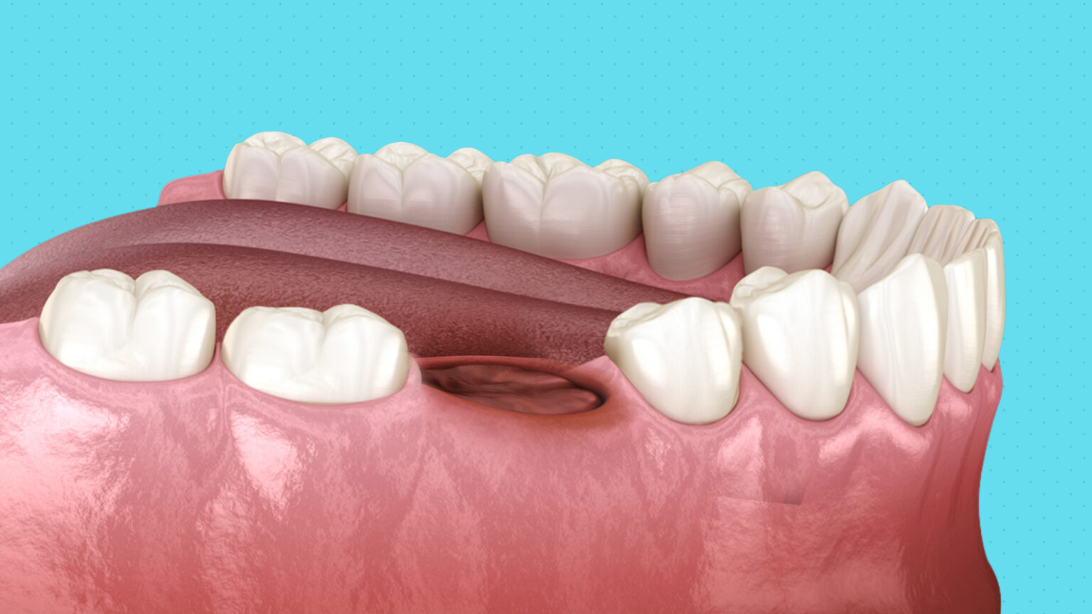 Dry Socket: Causes, Symptoms, Treatment and Prevention