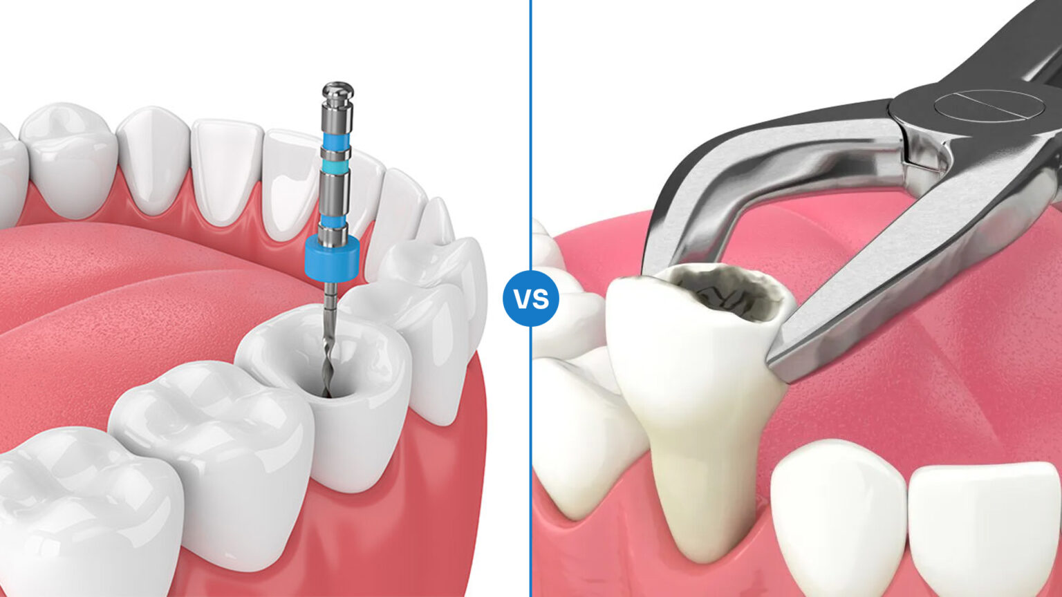 Which is the Better Choice: Root Canal vs. Tooth Extraction?
